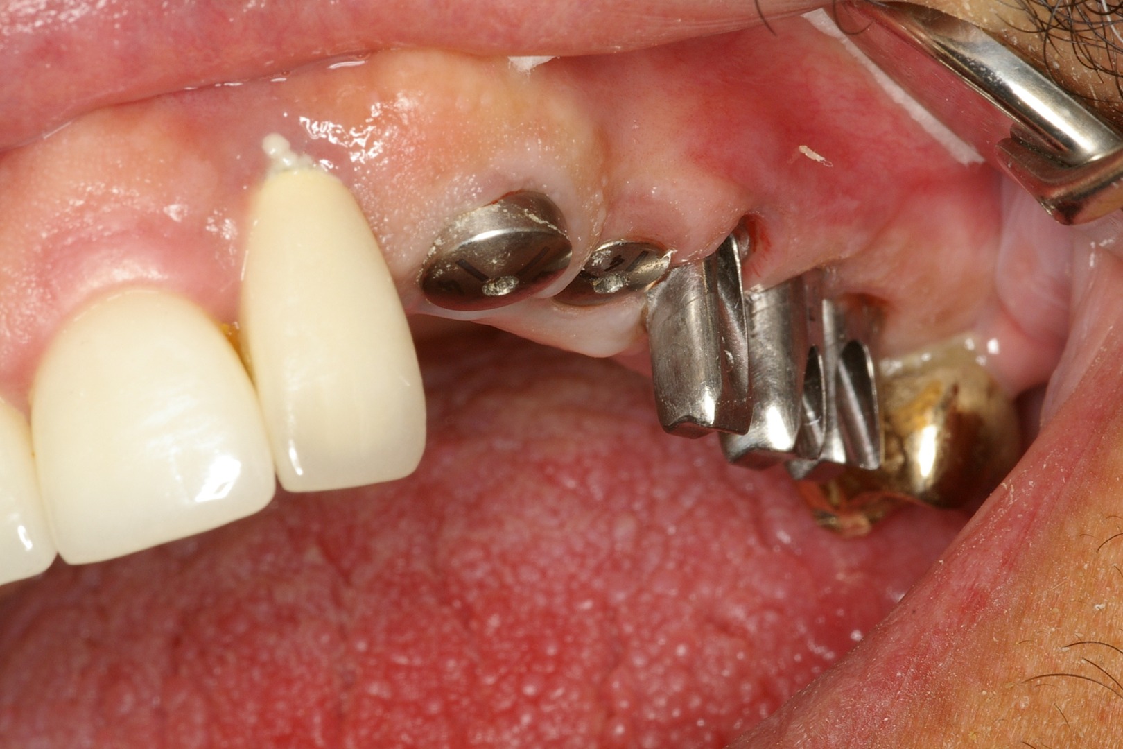 Dental Implants in Cave Creek, AZ | Tatum Creek Family Dentistry